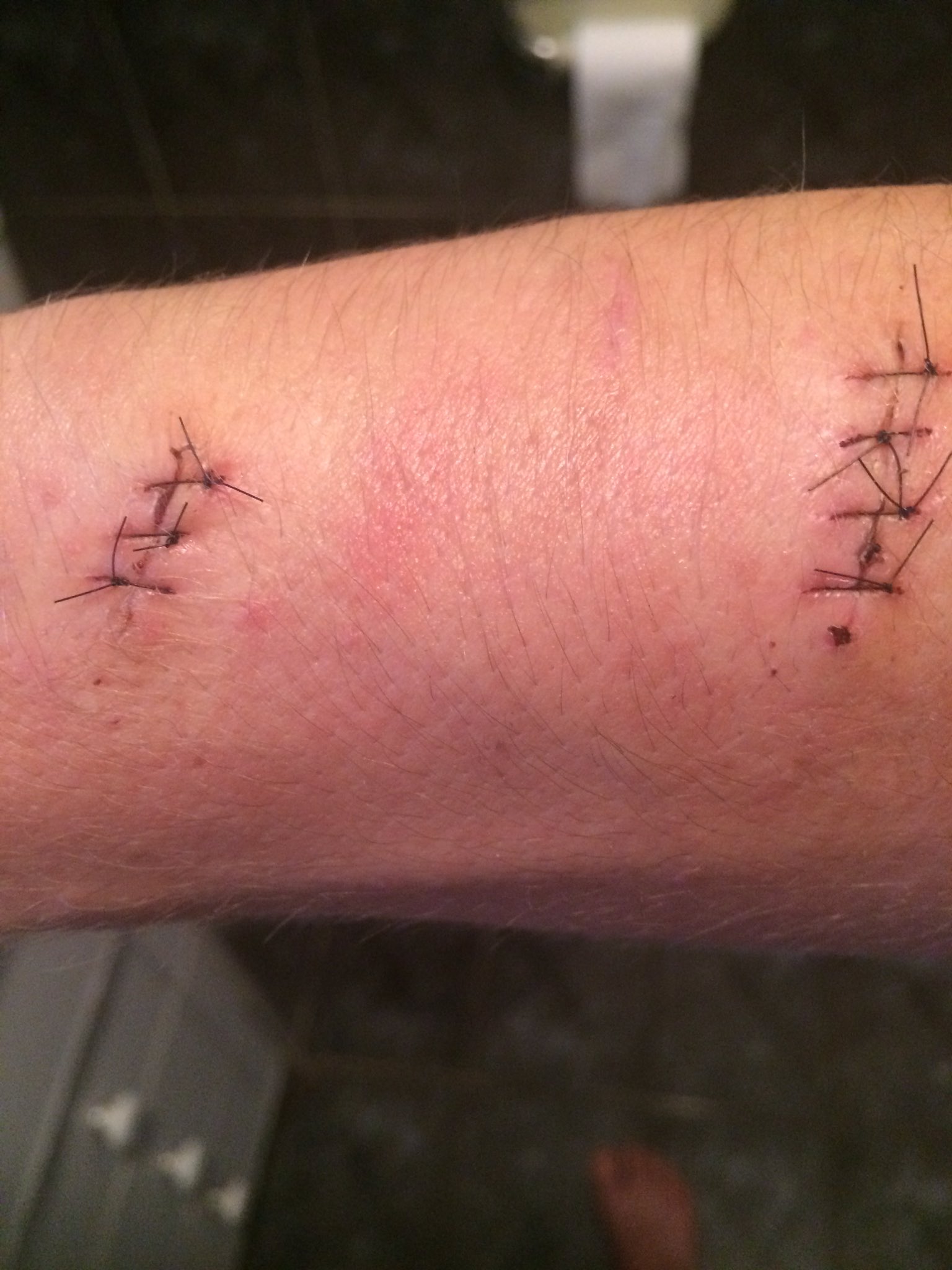 Forearm Stitches