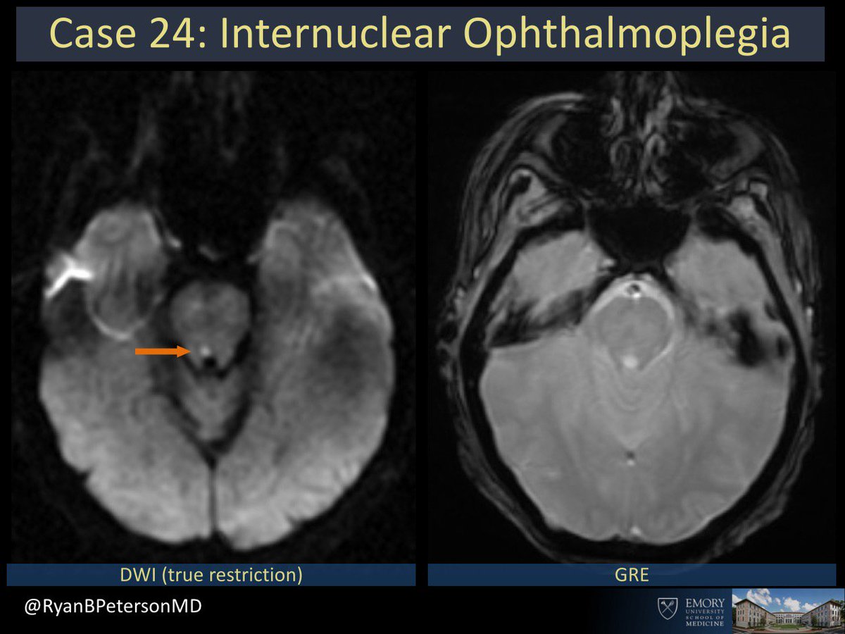 Internuclear Ophthalmoplegia Mri