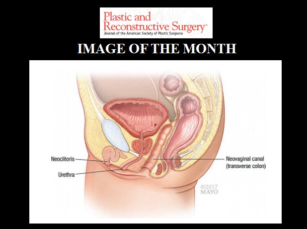 Transgender Anatomy Diagram