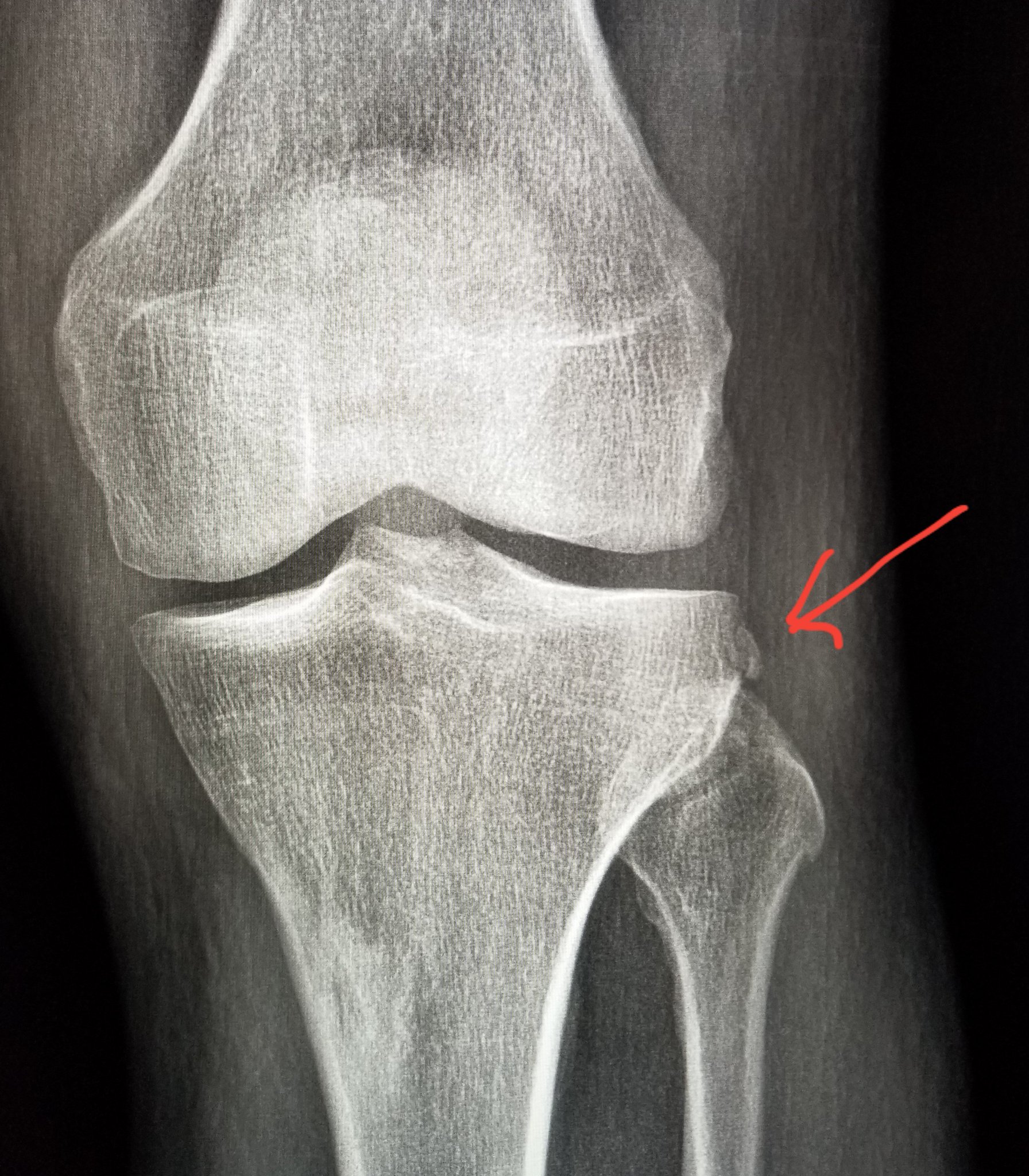 Sprain Knee X Ray