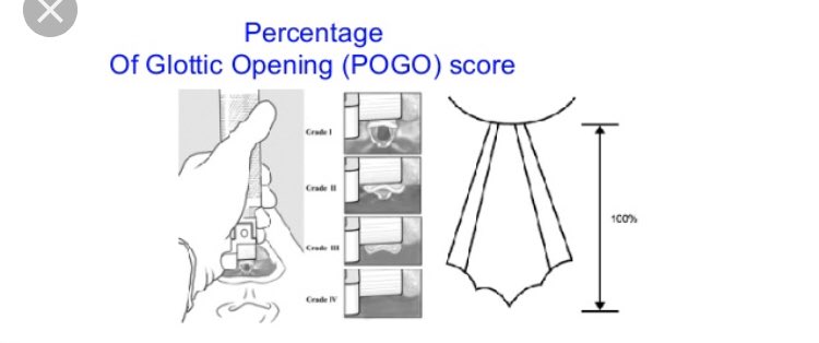 L'intubation difficile - [Société Française des Infirmier(e)s ...