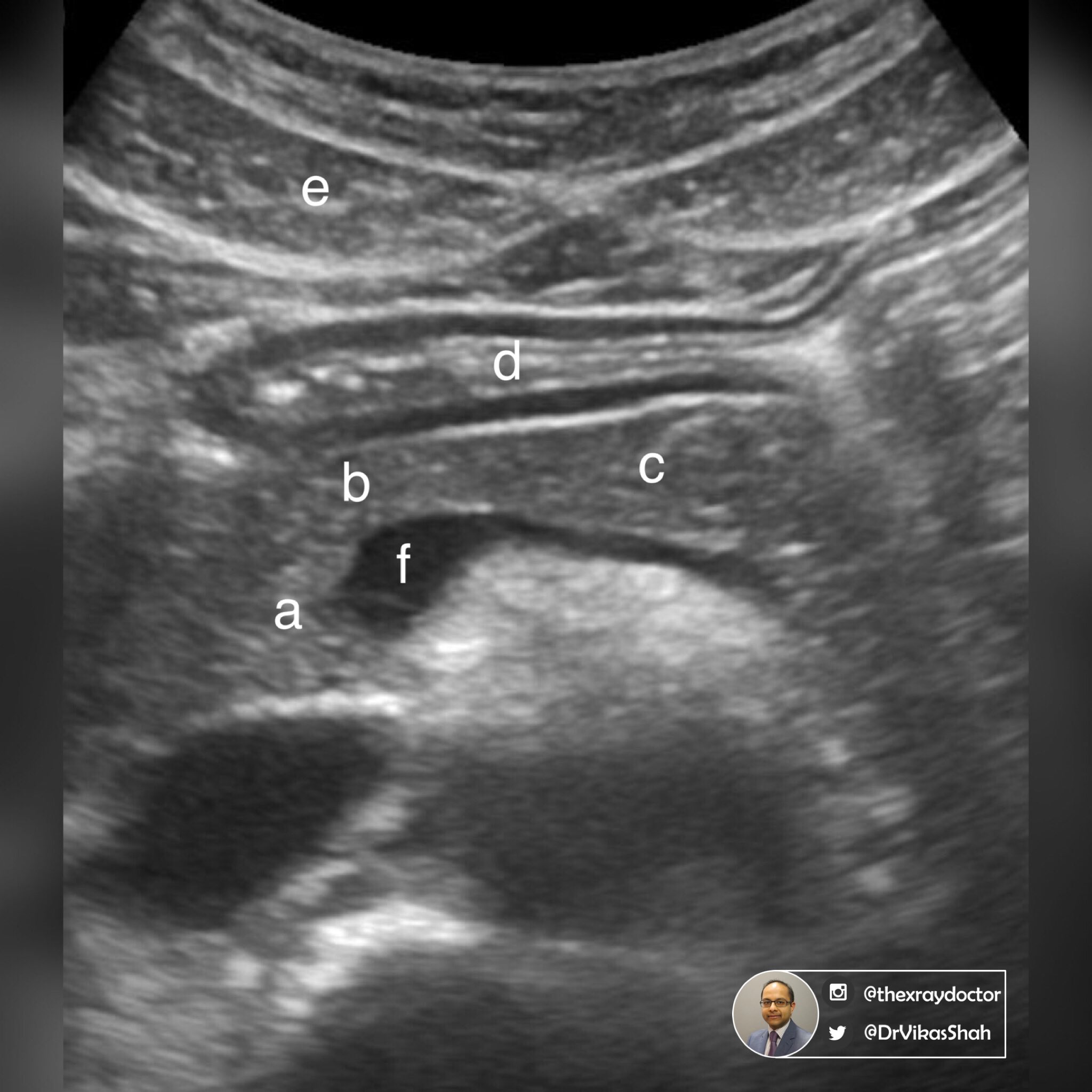 Pancreas Ultrasound Labeled