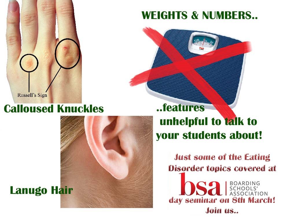 Russells Sign Bulimia