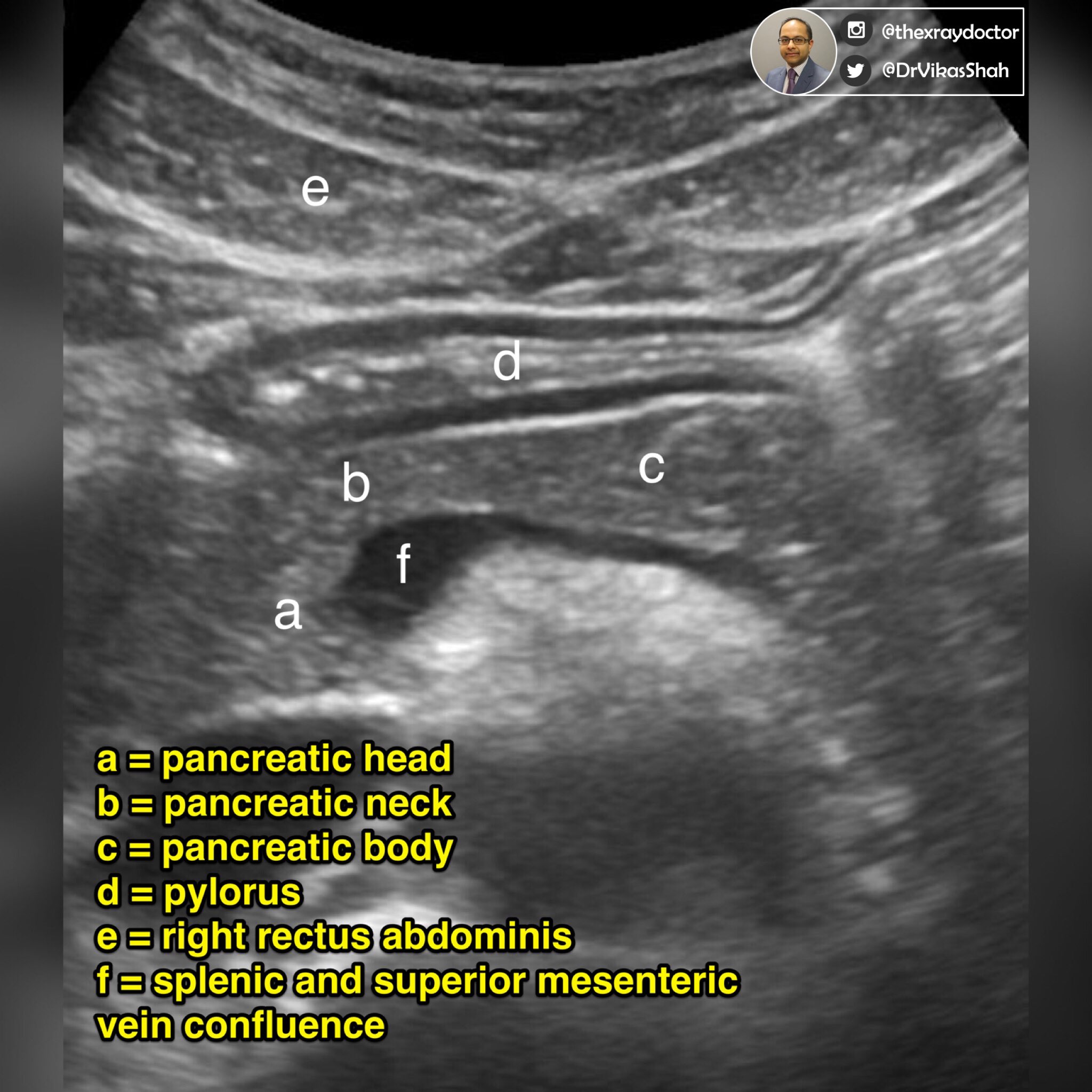 Pancreas Anatomy Ultrasound