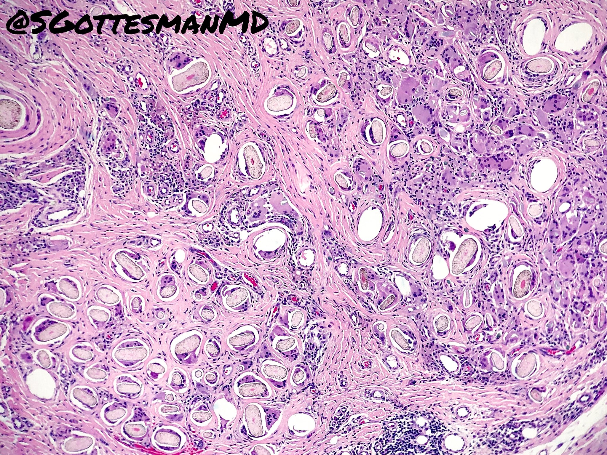 Pilonidal Cyst Histology