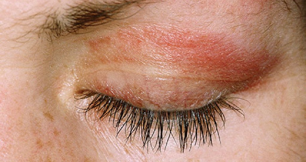 What Causes Rashes On Eyelids