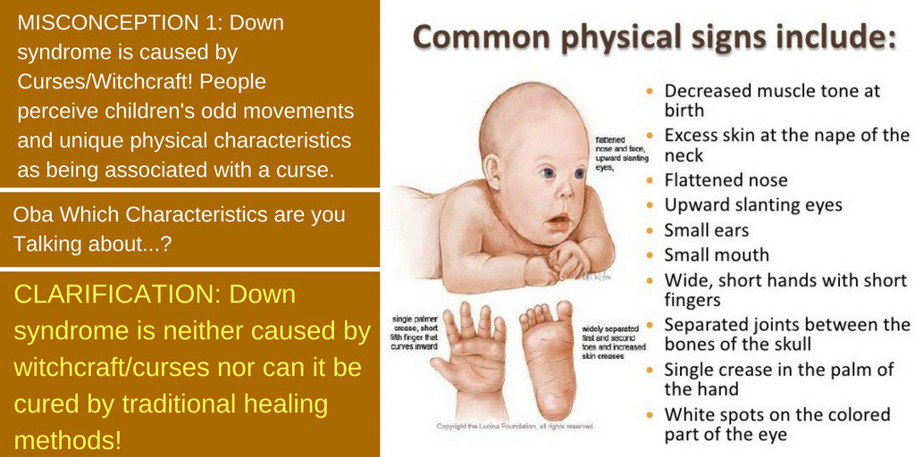 Down Syndrome Hand Characteristics