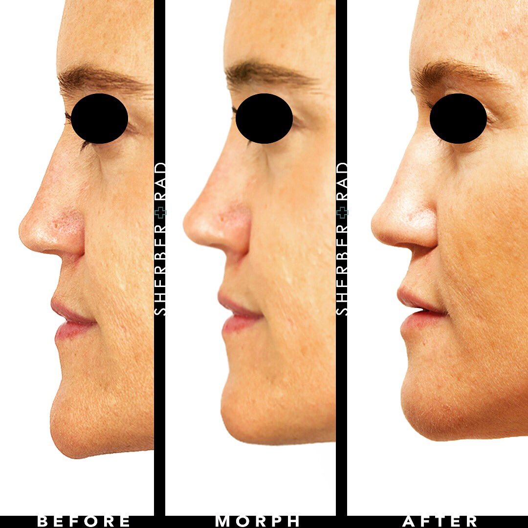 Pointy Chin Reduction