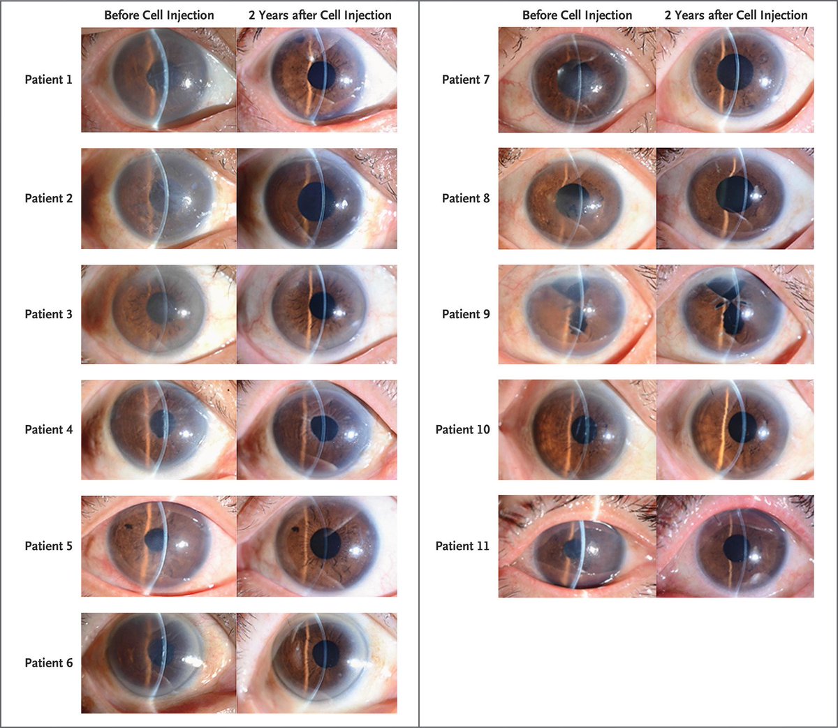 Phase 1 study shows injection of human corneal endothelial cells (CECs ...