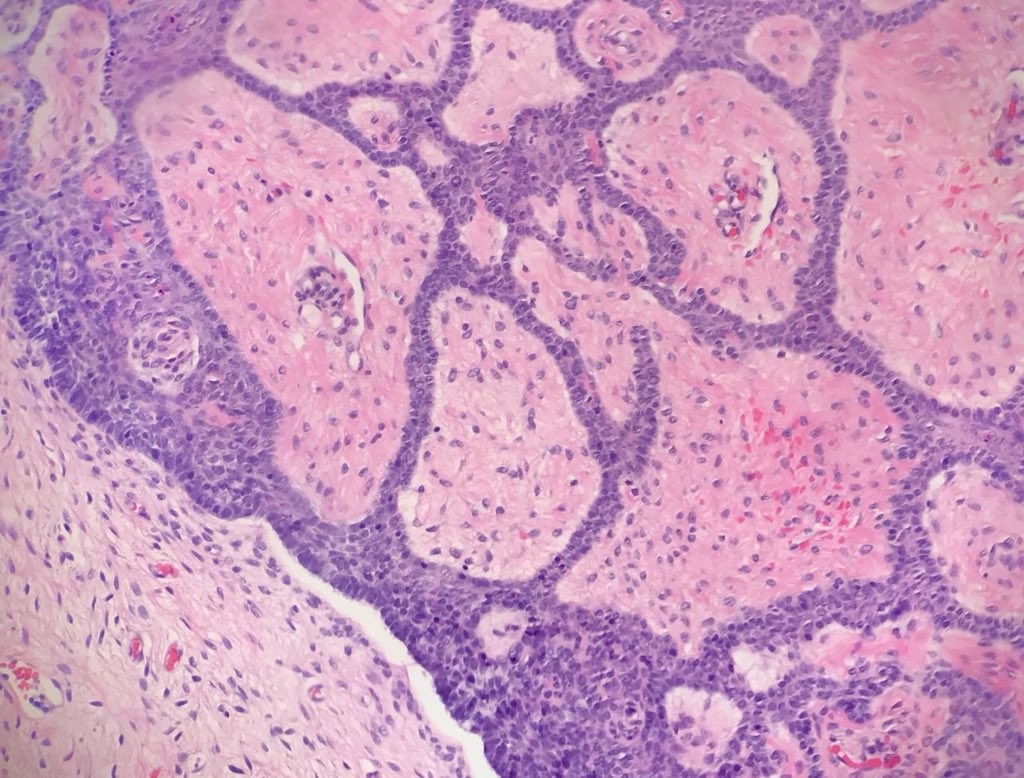 Fibroepithelioma Of Pinkus
