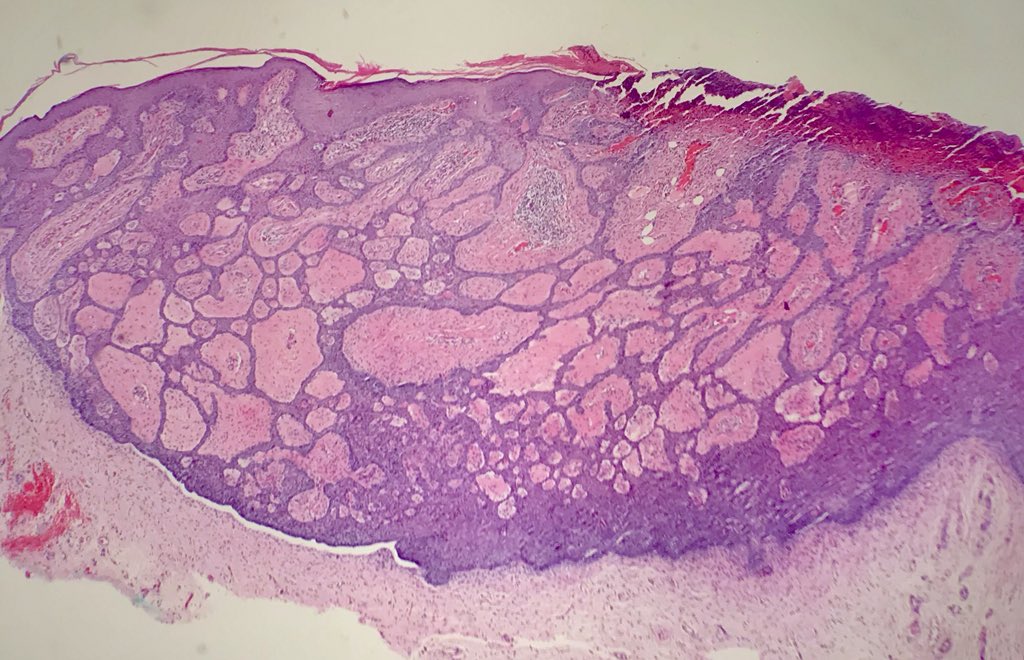 Fibroepithelioma Of Pinkus