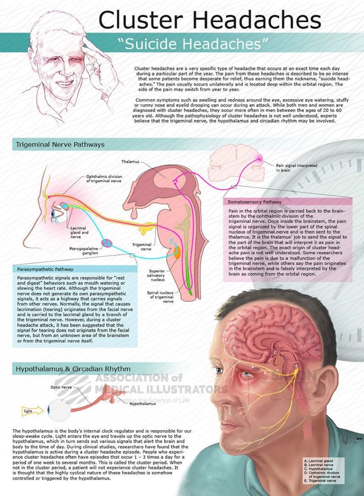 Cluster Headaches Treatment
