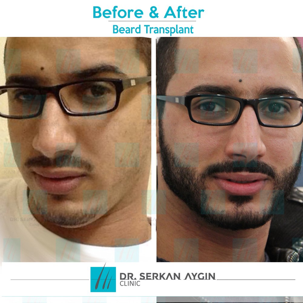 Dr Serkan Aygin On Twitter What To Expect From A Beard Transplant