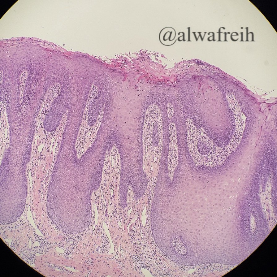 Geographic Tongue Histology