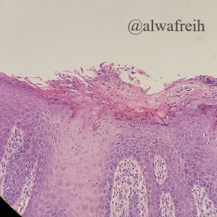 Geographic Tongue Histology