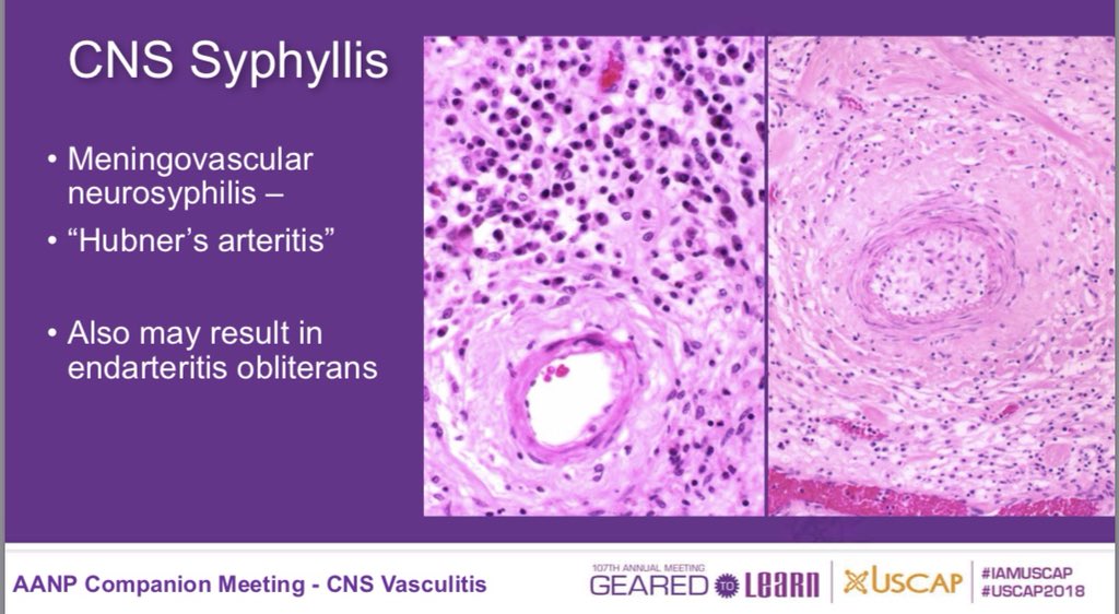 Neurosyphilis Histology