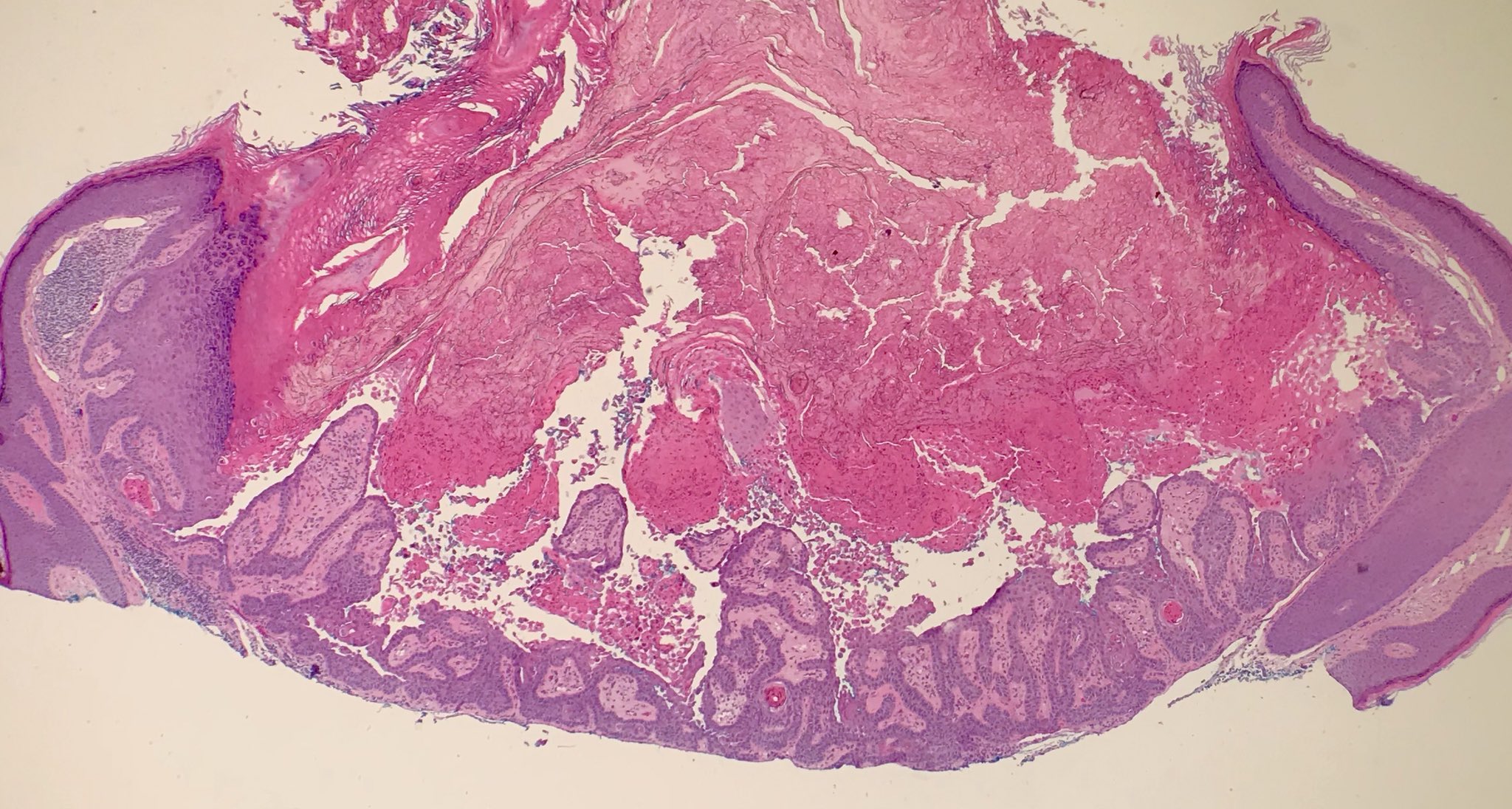 Warty Dyskeratoma