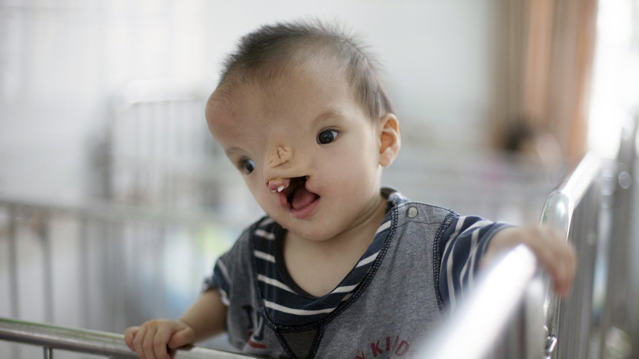 Agent Orange Birth Defects