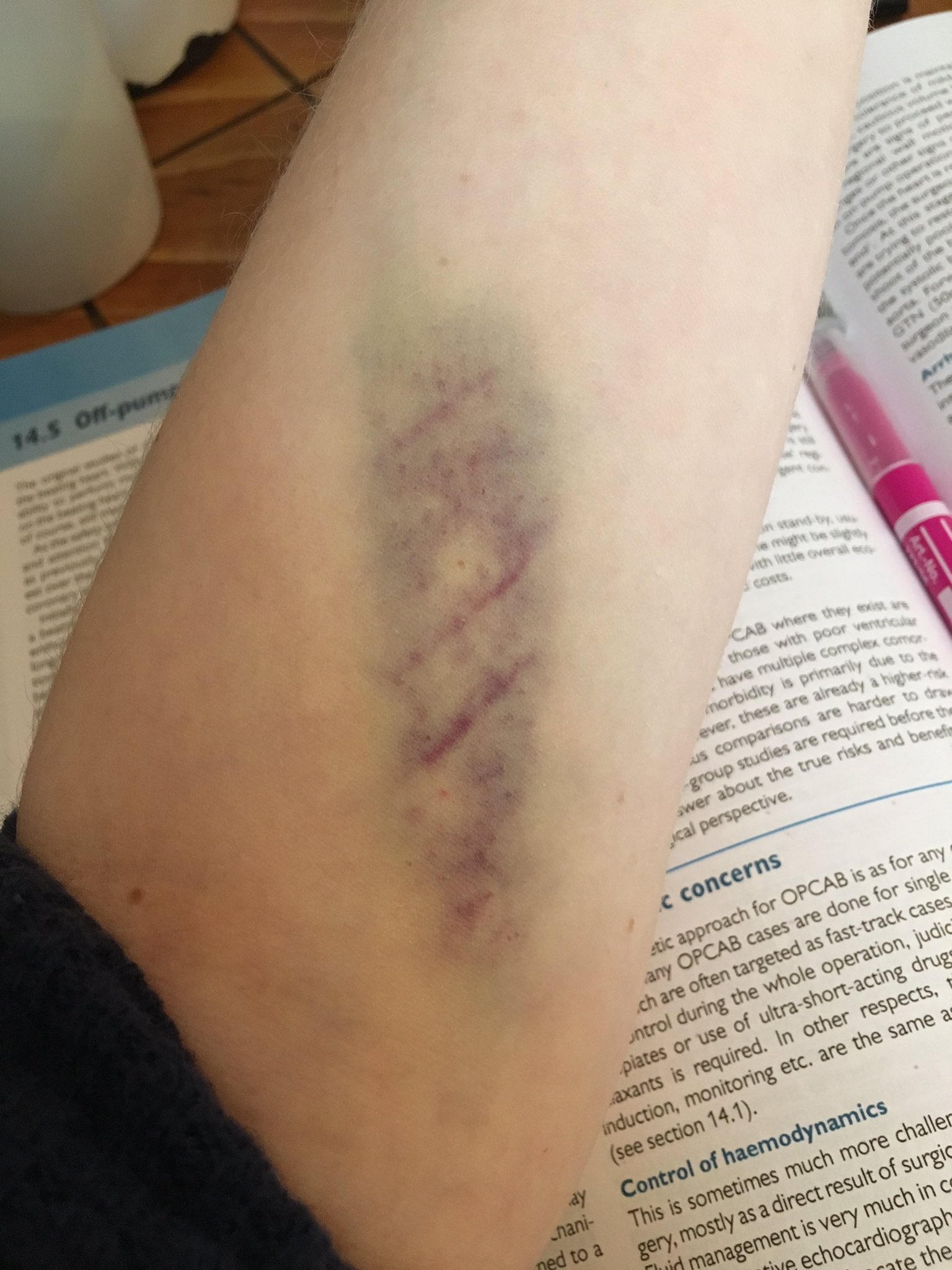 Natalie Silvey On Twitter Bruising Is A Funny Thing Two Blood Tests And My Arm Looks Like natalie-silvey-on-twitter-bruising-is-a-funny-thing-two-blood-tests-and-my-arm-looks-like