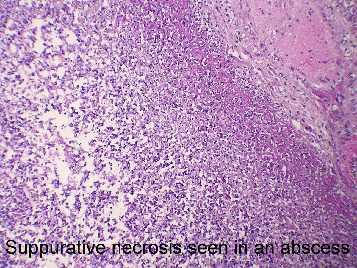 Caseous Necrosis Vs Liquefactive Necrosis