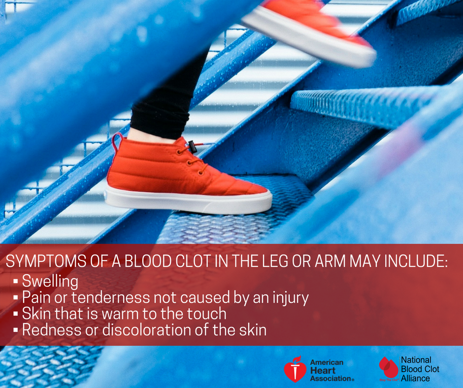 Knowing the symptoms of a deep vein thrombosis (DVT), or blood clot in ...