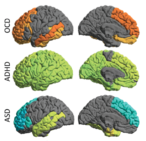 Autism Brain Comparison