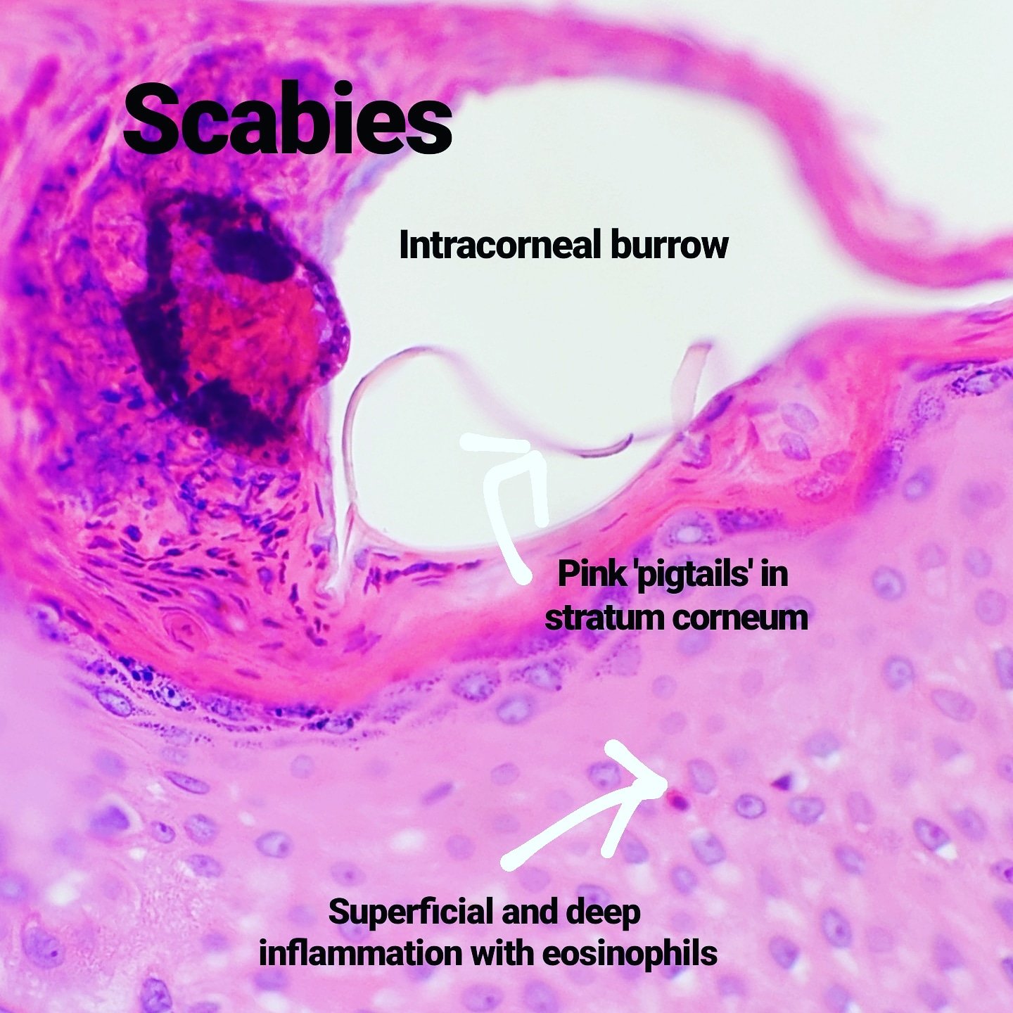 Scabies Eggs Under Microscope