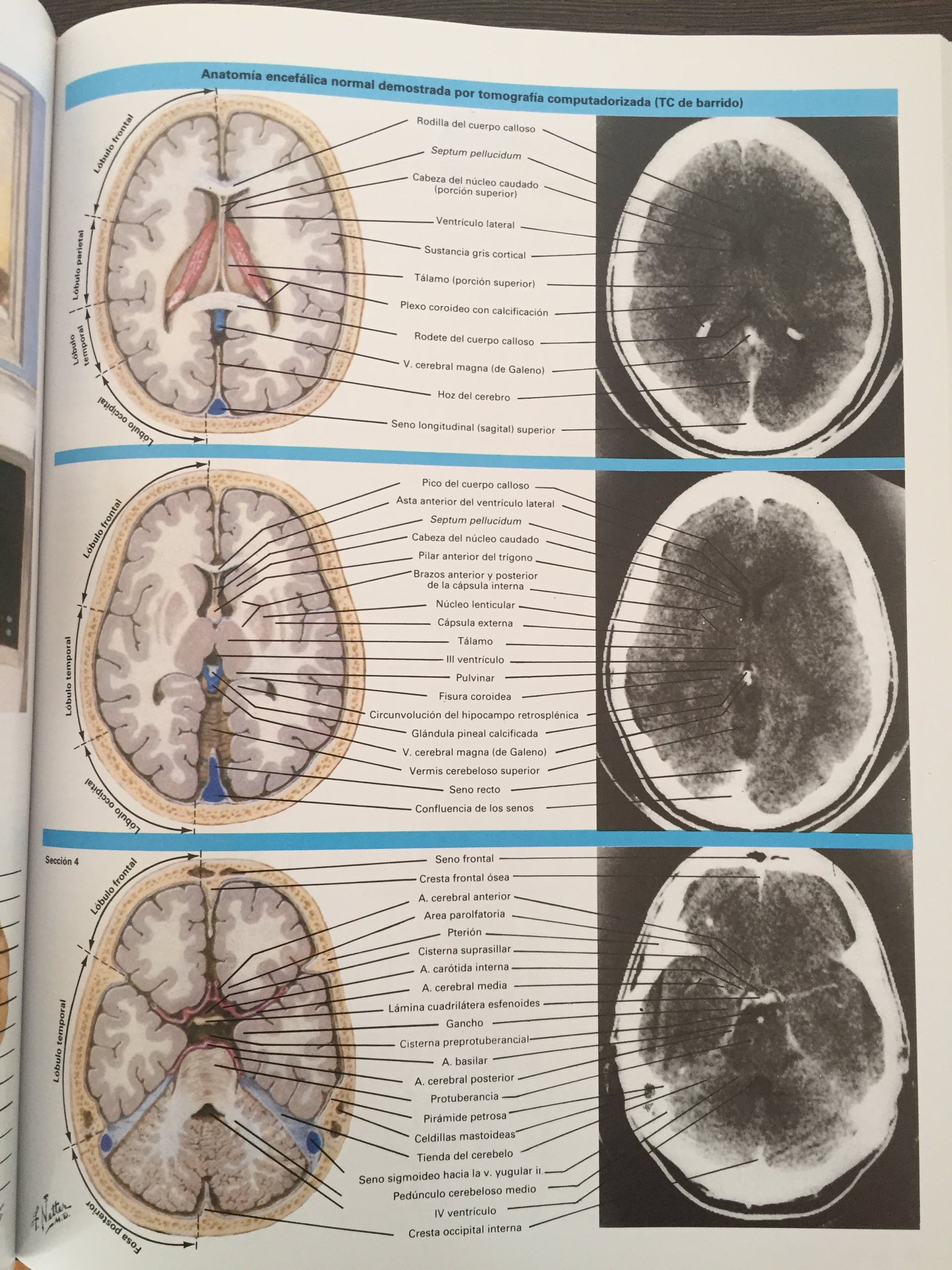 Anatomía Cerebral Normal Por Tc Anatomia: TC De CRÂNIO