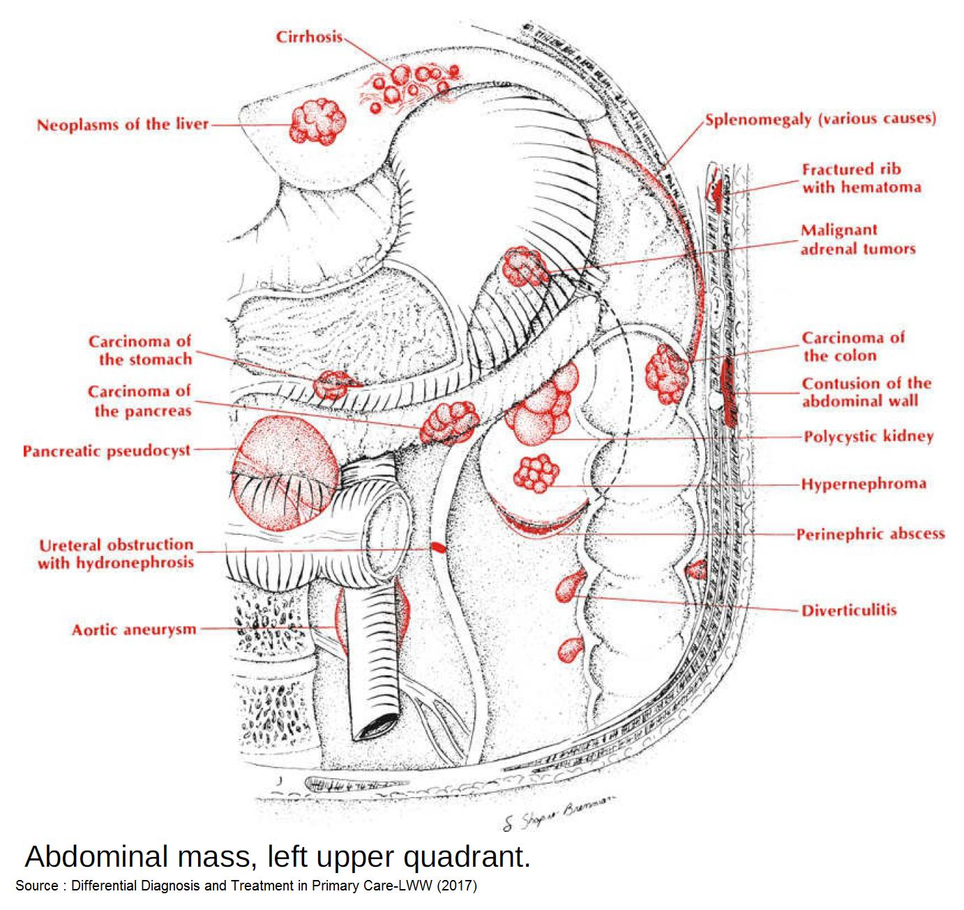 Upper Left Abdominal Pain