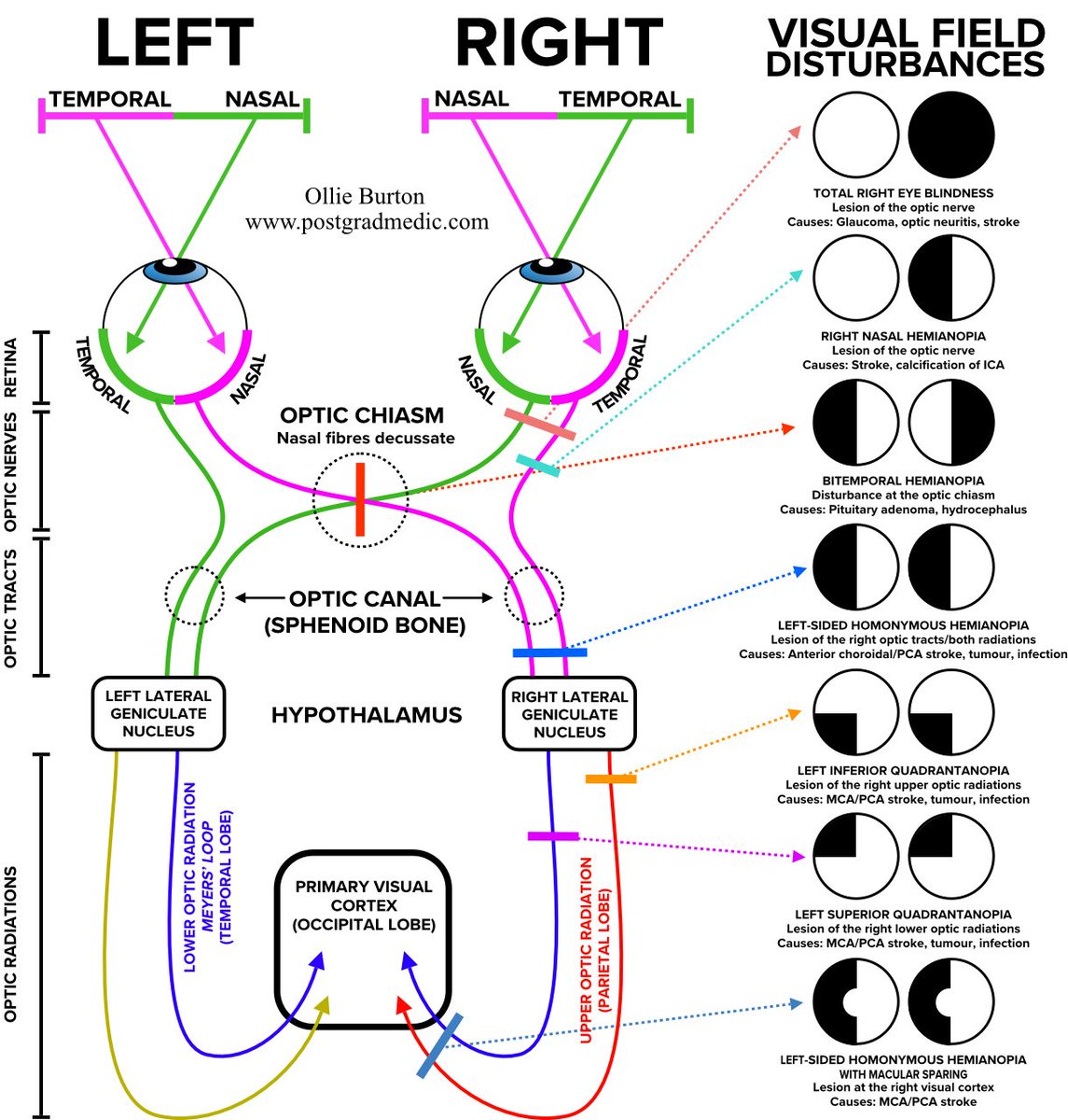 Quadrantanopia Wikipedia