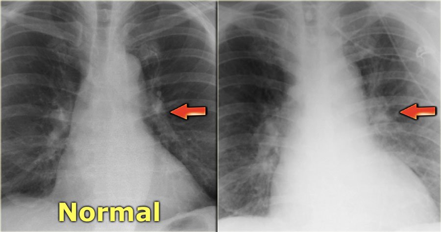Peribronchial Cuffing