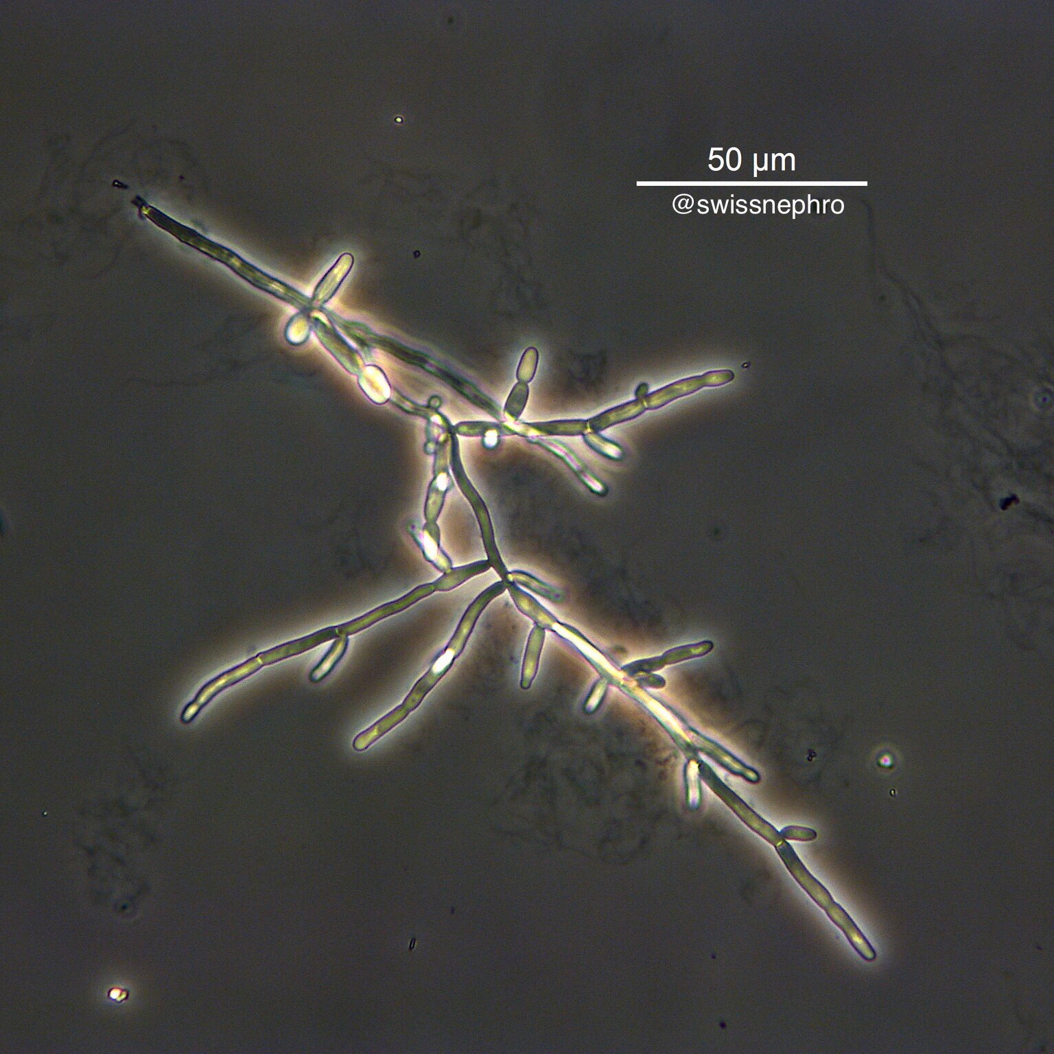 Pseudohyphae In Urine