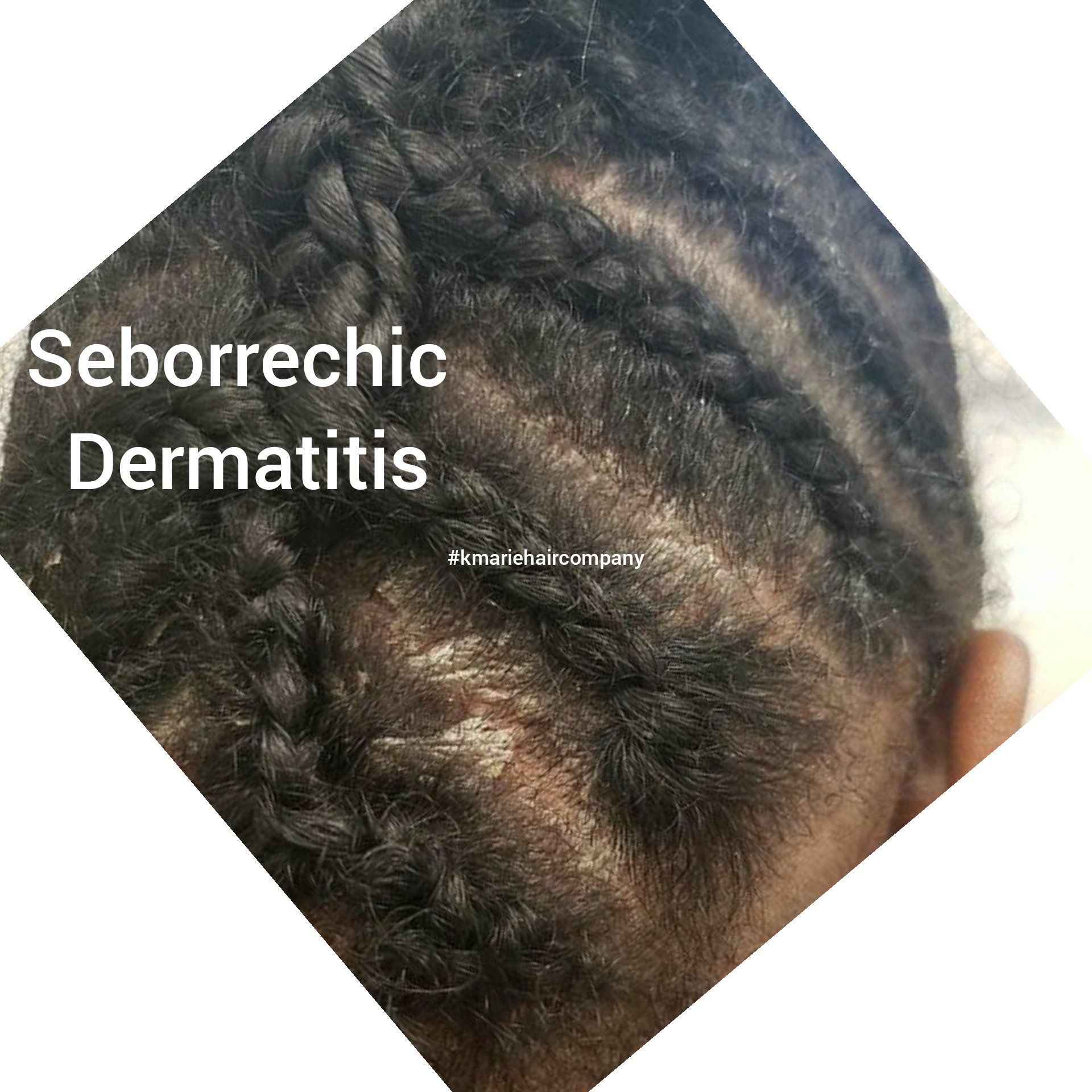 Dandruff Vs Seborrheic Dermatitis