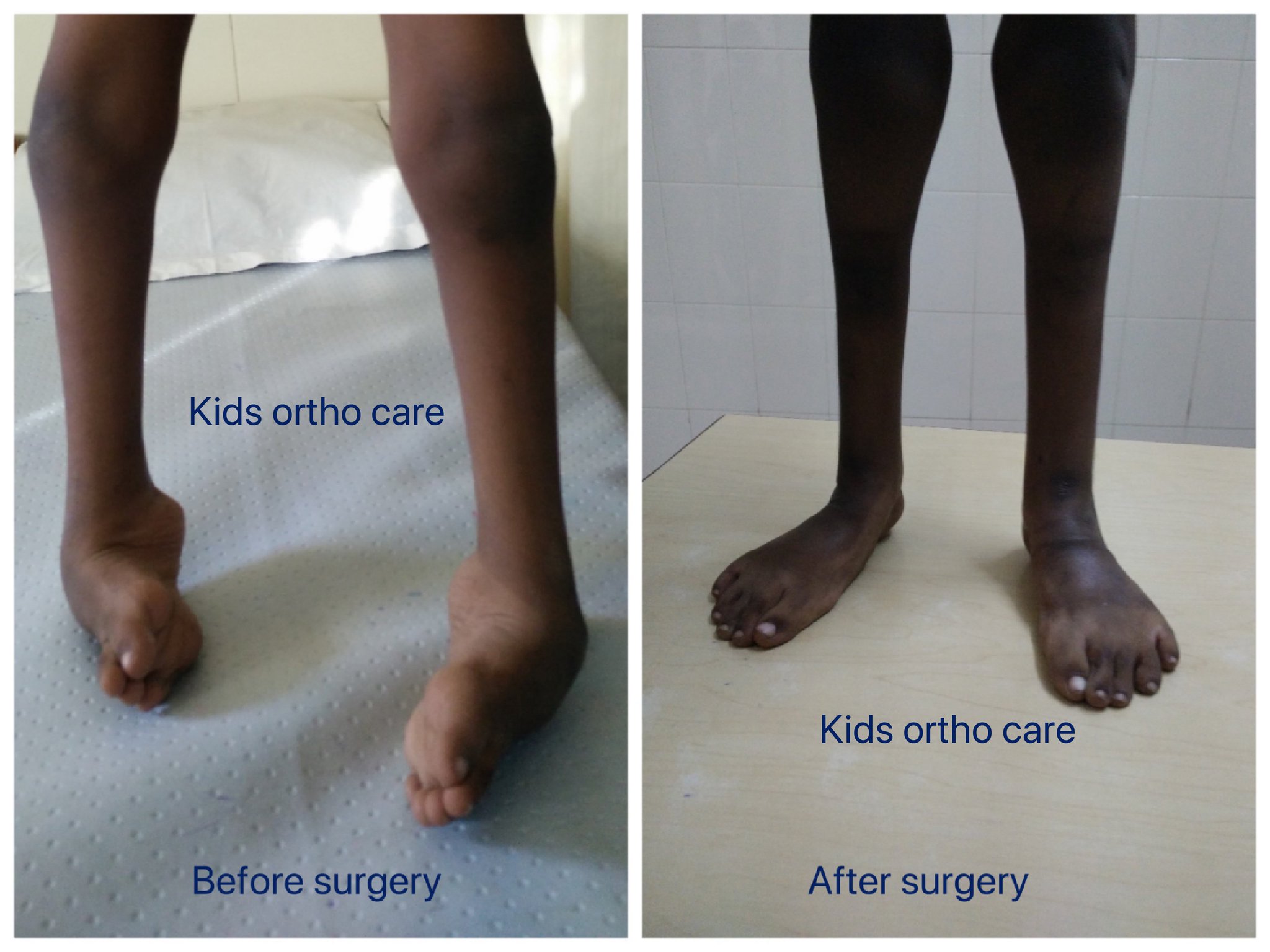 Club Foot Before And After