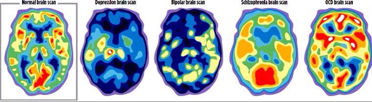 Schizophrenia Brain Activity