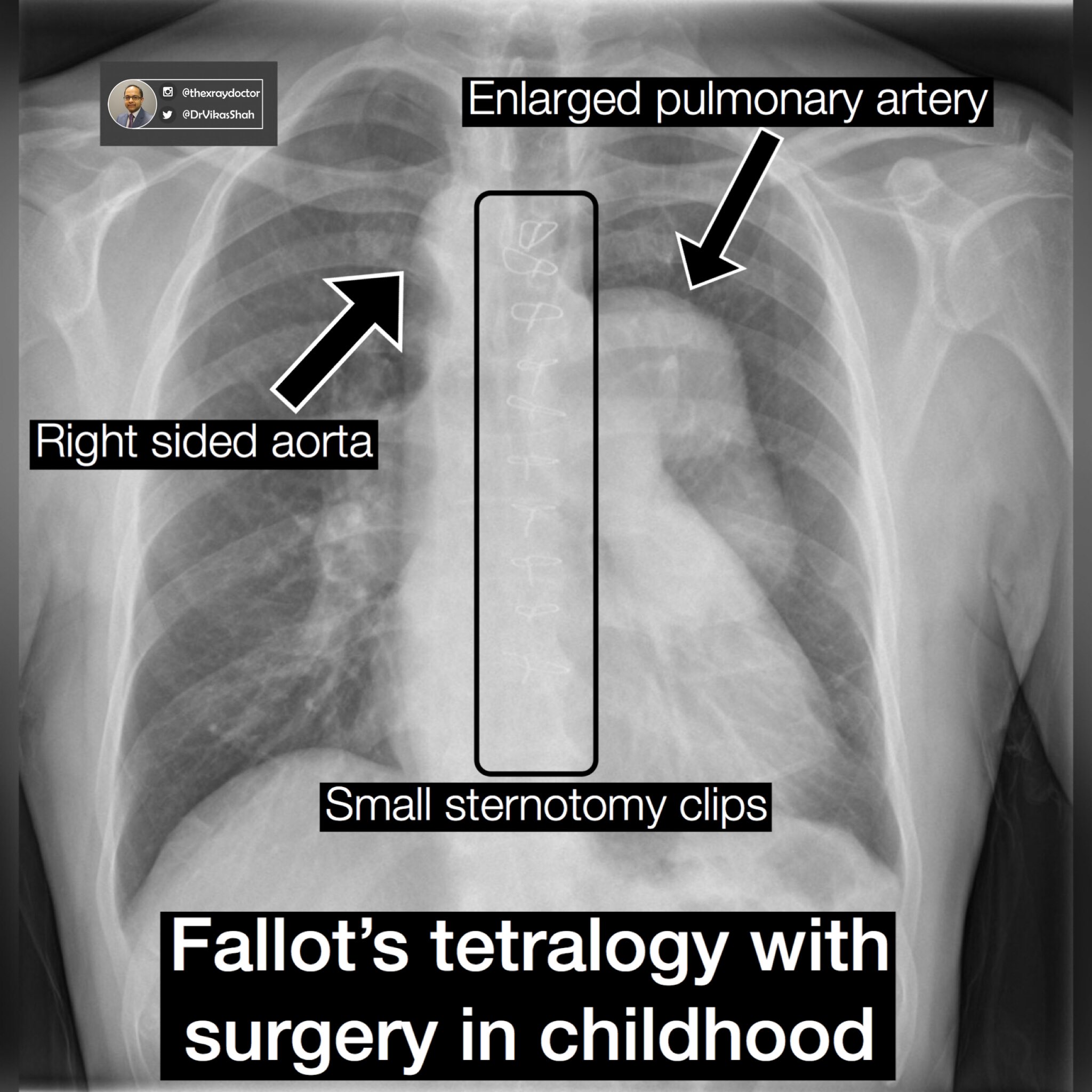 Tetralogy Of Fallot X Ray