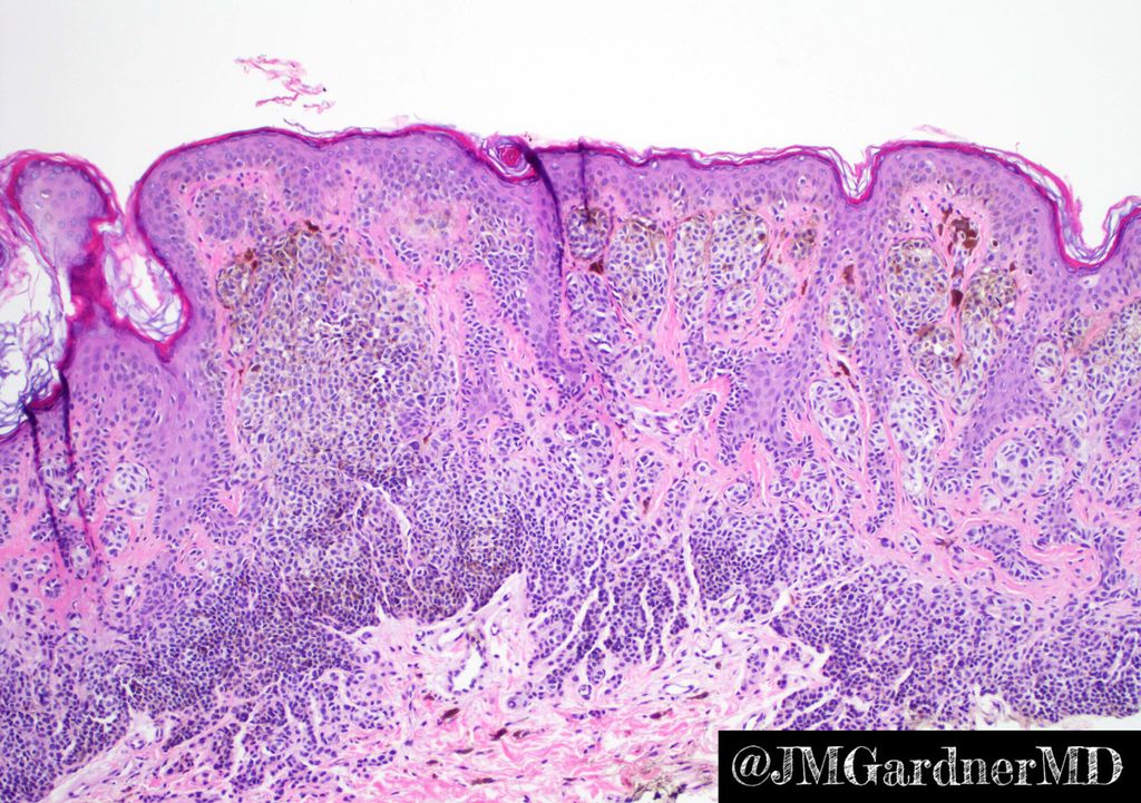 Benign Nevus Histology Intramucosal Melanocytic Nevi | CCIDE