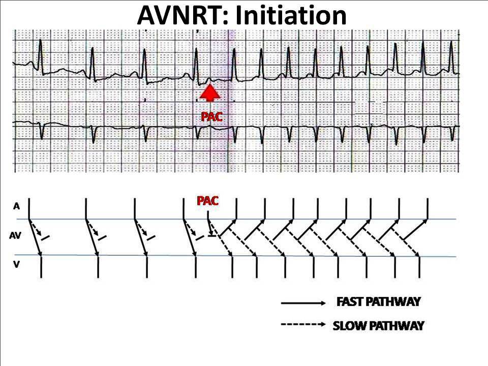 Av Nodal Reentrant Tachycardia
