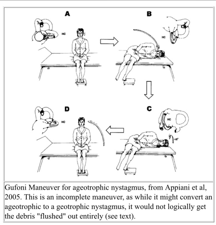 Modified Epley Maneuver At Home