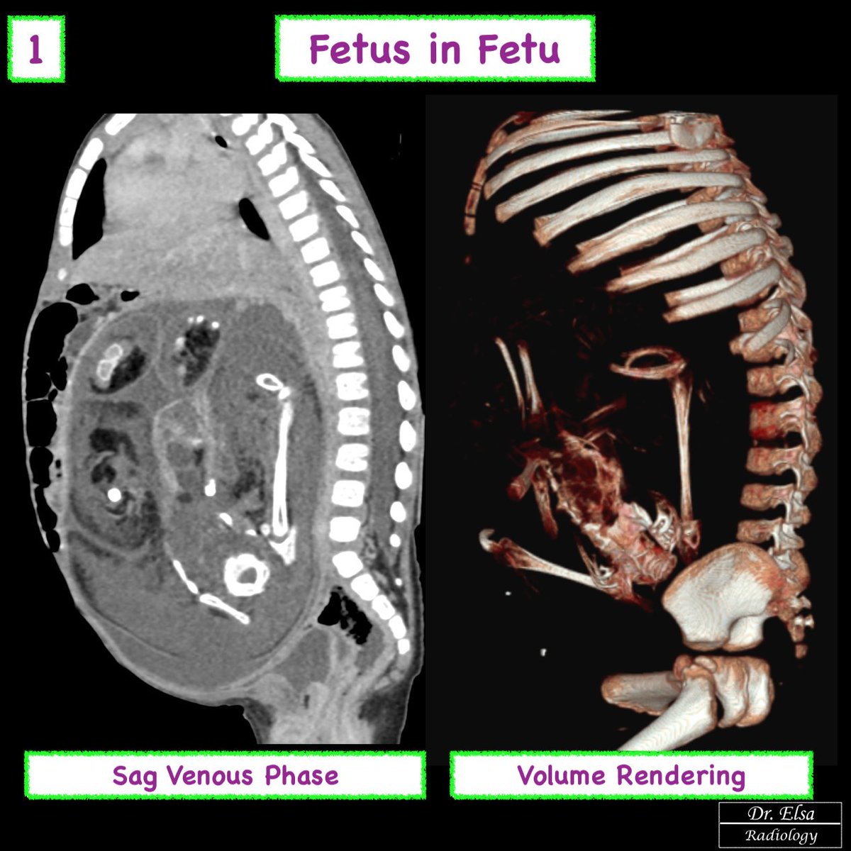 Fetus In Fetu Xray