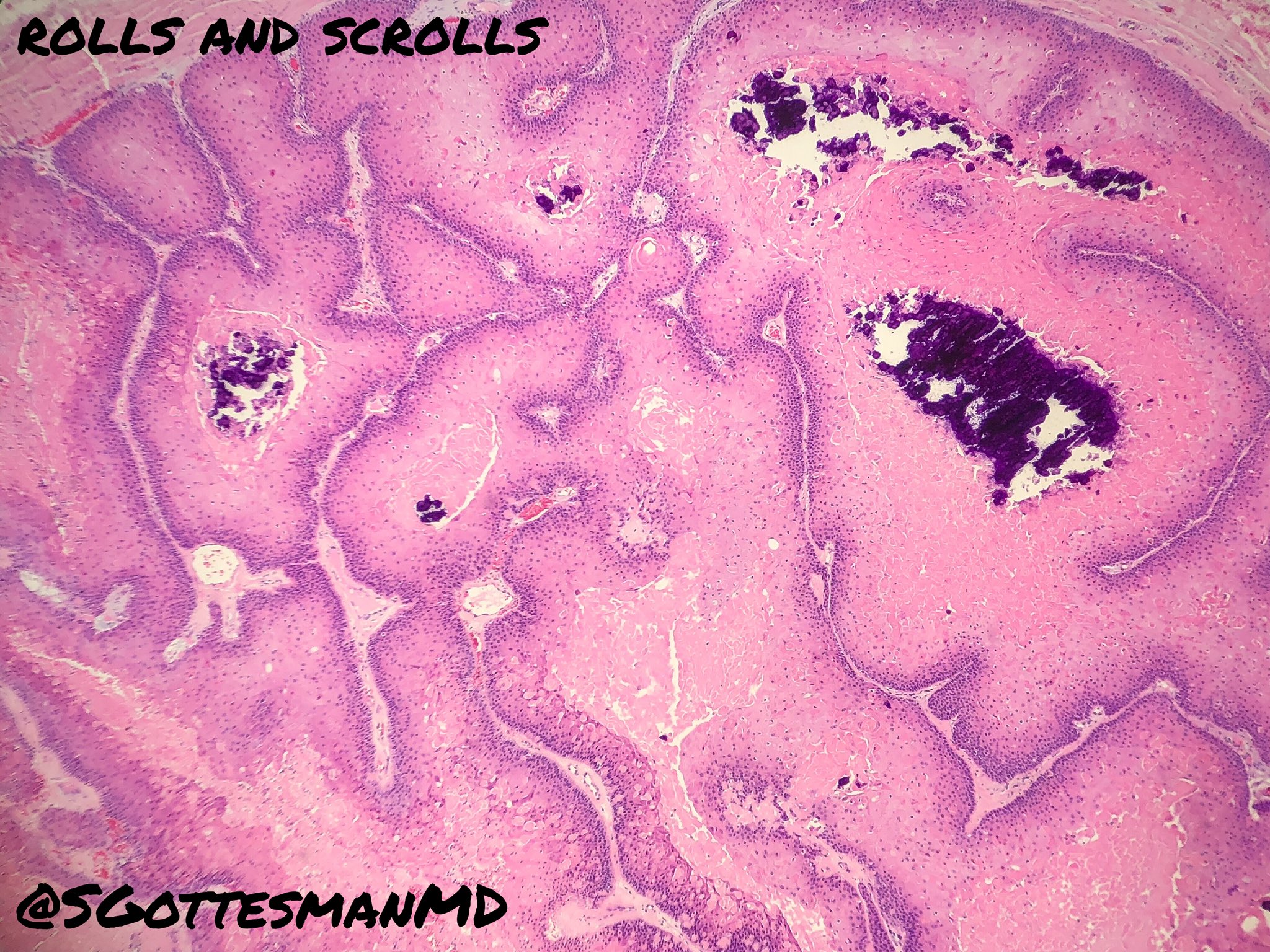 Proliferating Pilar Cyst