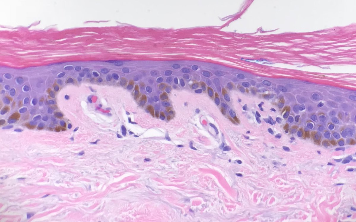 Ichthyosis Vulgaris Histology
