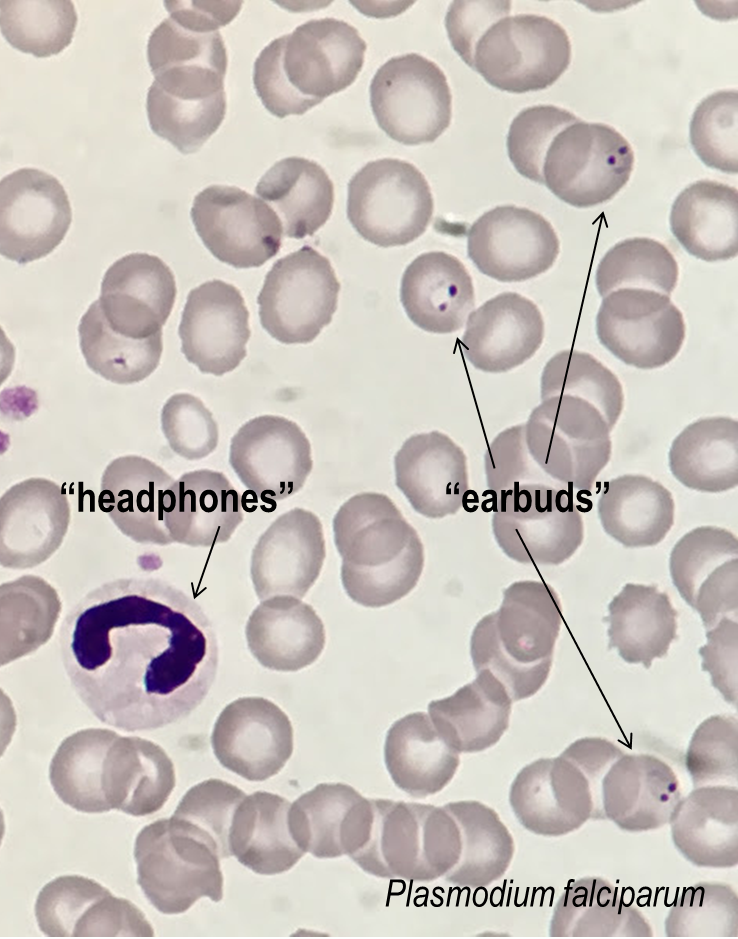 Plasmodium Falciparum Ring Stage