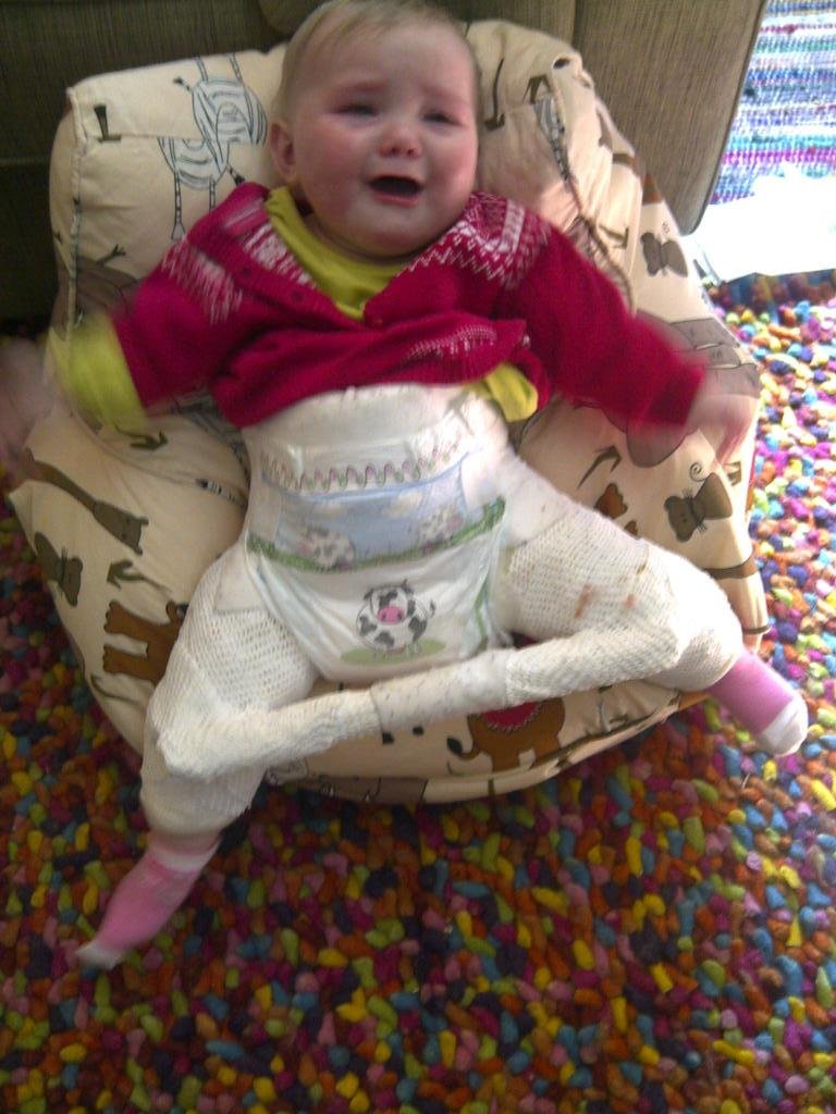 Single Hip Spica Cast Tips For Caring For Your Child In A Spica Cast