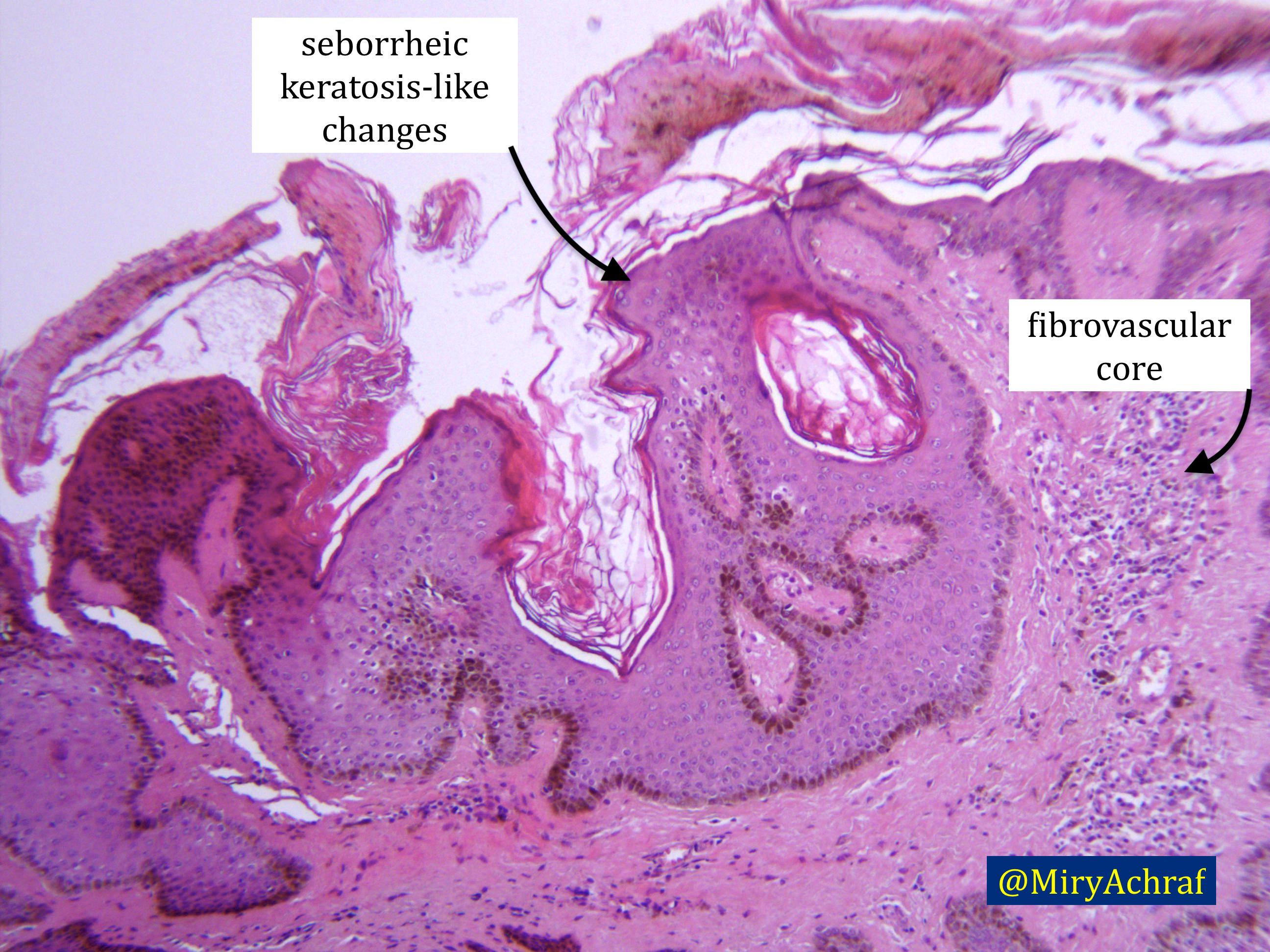 Fibroepithelial Polyp Histology