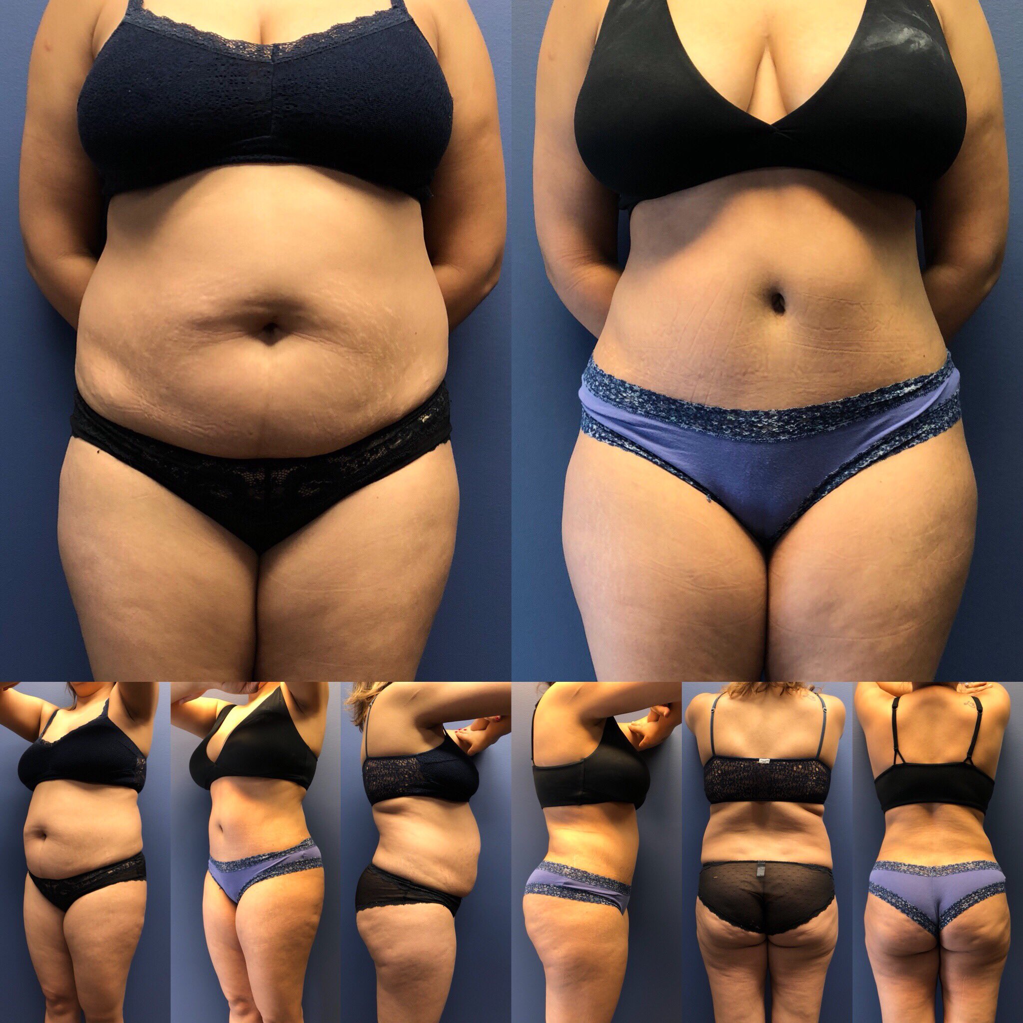 Jason Petrungaro, MD, FACS on Twitter: "IT’S TUMMY TUCK TUESDAY!! Check out these gorgeous ...