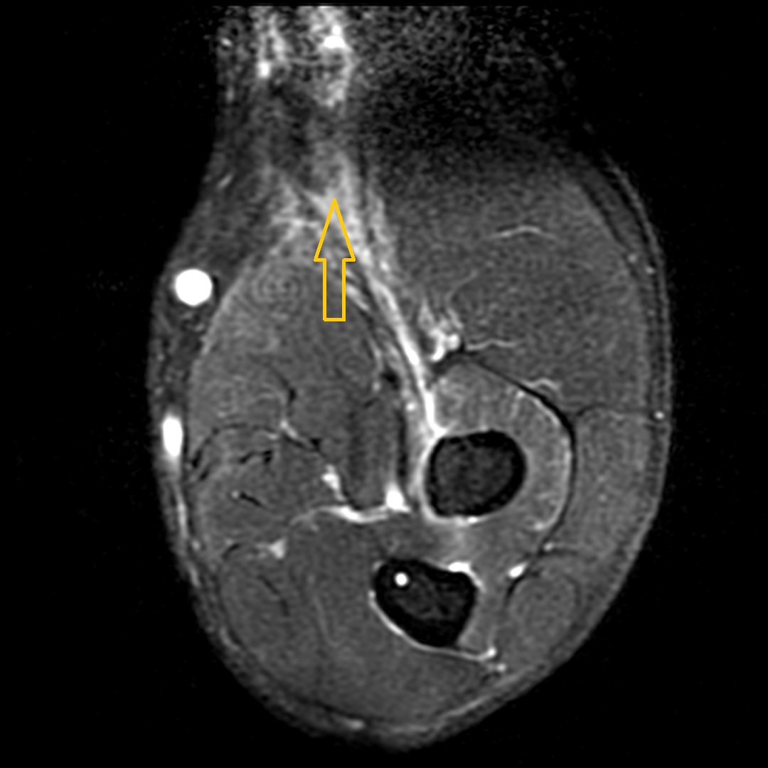 Distal Bicep Tendon Mri