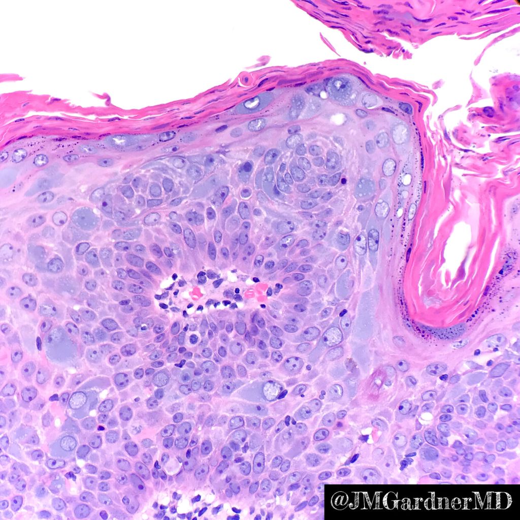 Epidermodysplasia Verruciformis Histology Sebaceous Cell Carcinoma