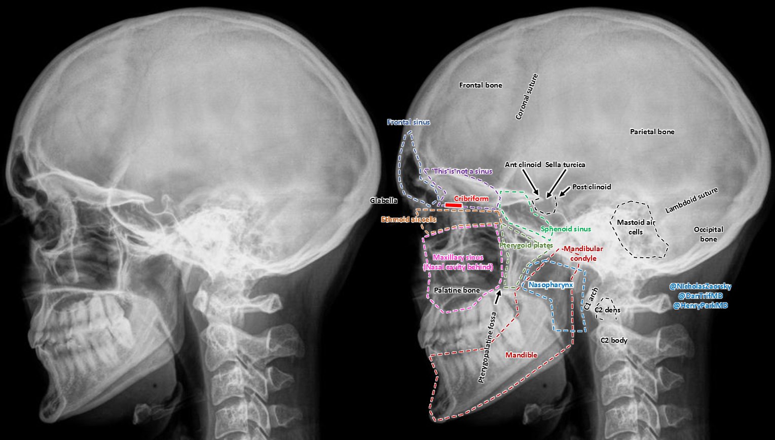 X Ray Of Skull Anatomy Skull | Radiology Key