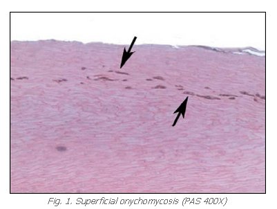 Onychomycosis Histology